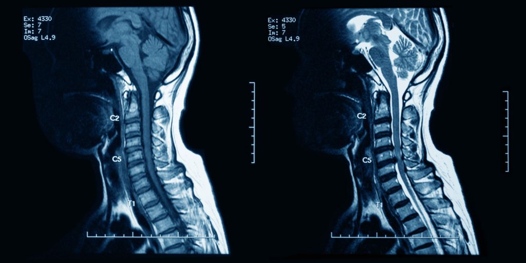 Cervical MRI Scan: What to Know About Imaging Your Neck and Upper Spine ...