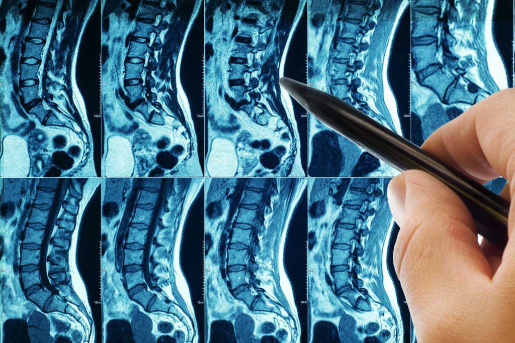 Lumbar Spine CT Scan: Diagnosing Lower Back Problems - IPMC ...